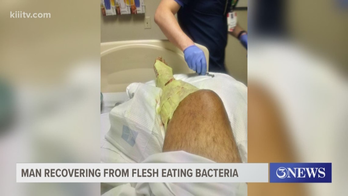 Coastal Bend Man Recovering From Flesh Eating Bacteria Vibrio