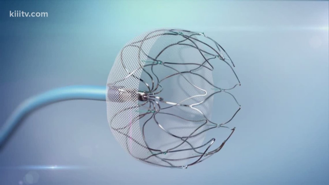 New 'Watchman' procedure to lessen risk of stroke in the Coastal Bend ...